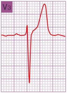 標準12誘導心電図 – 標準12誘導の基本波形 – 9 | 心電図の基本知識 | ECG-Cafe