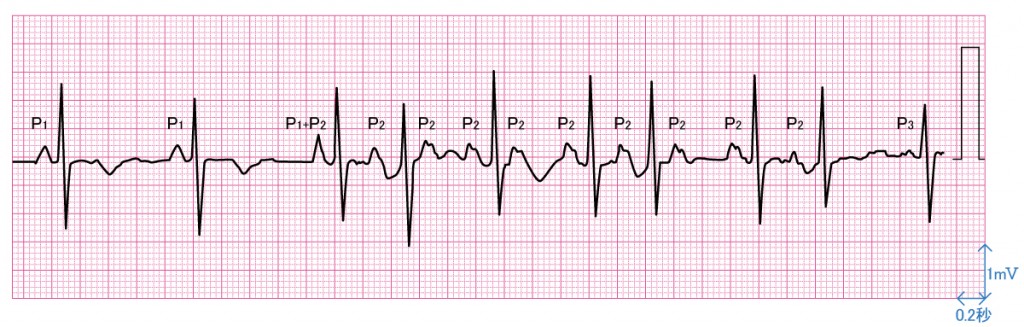 心房頻拍 – 波形と特徴 | 不整脈の種類 | ECG-Cafe