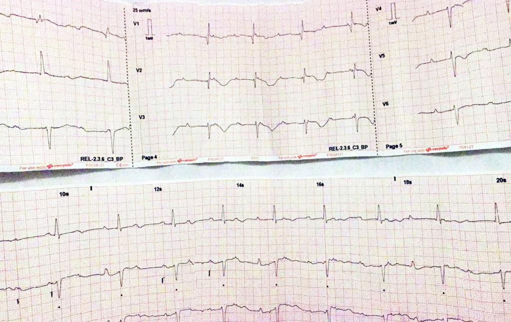 完全房室ブロック | ECG-Cafe