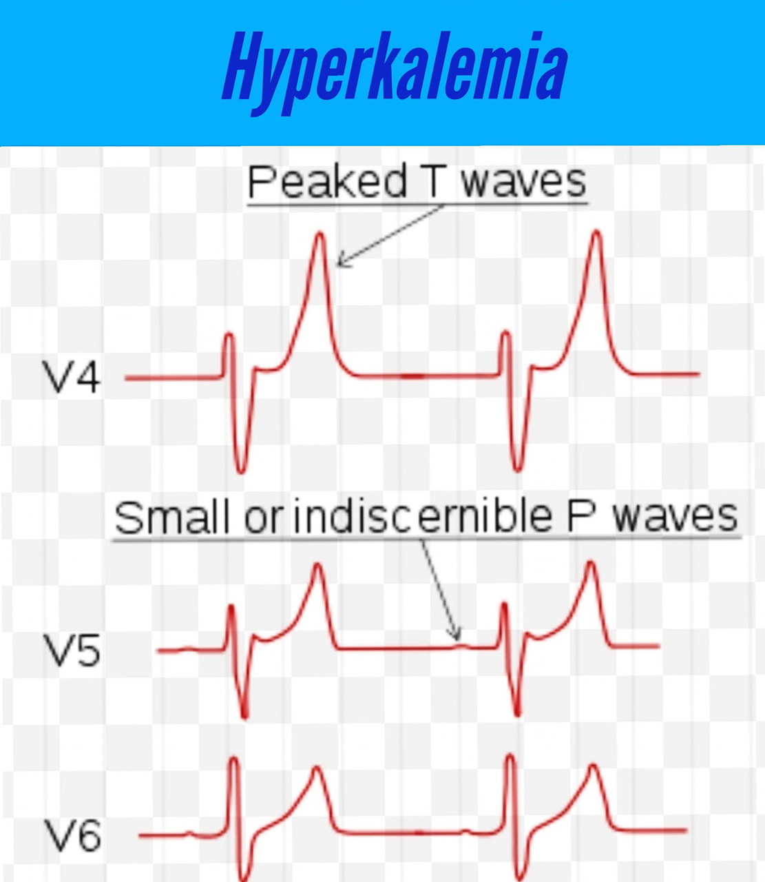 高カリウム血症 | ECG-Cafe