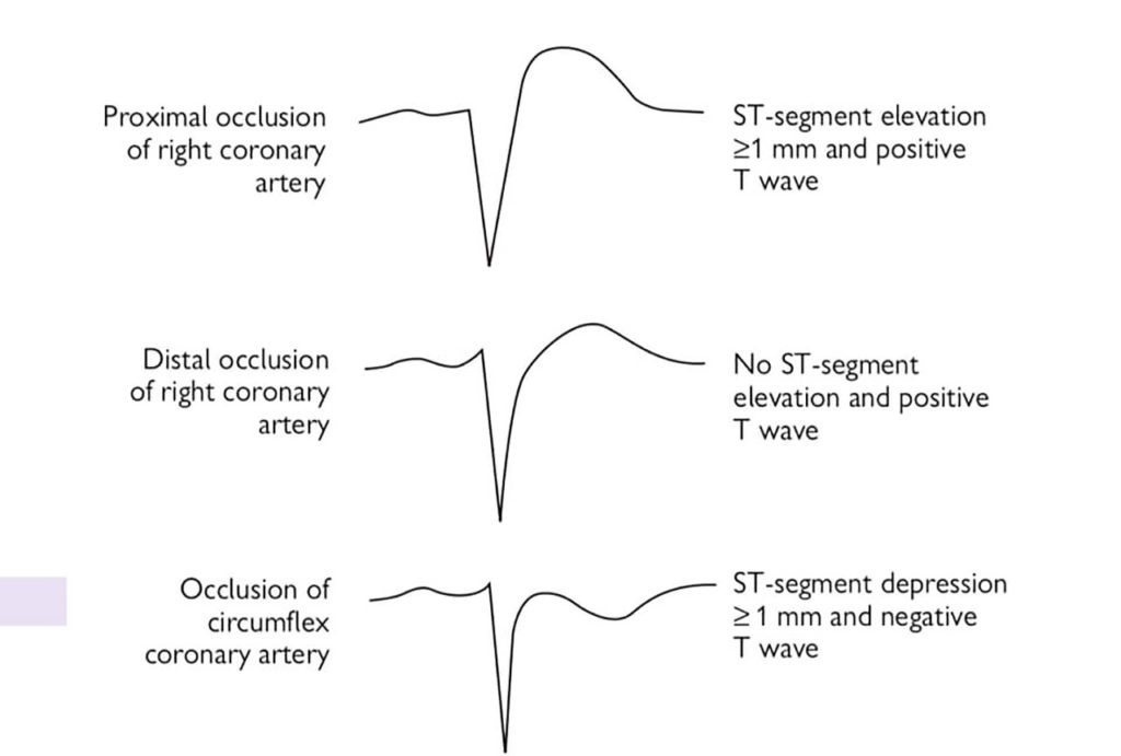 AMIでの右側胸部誘導 | ECG-Cafe