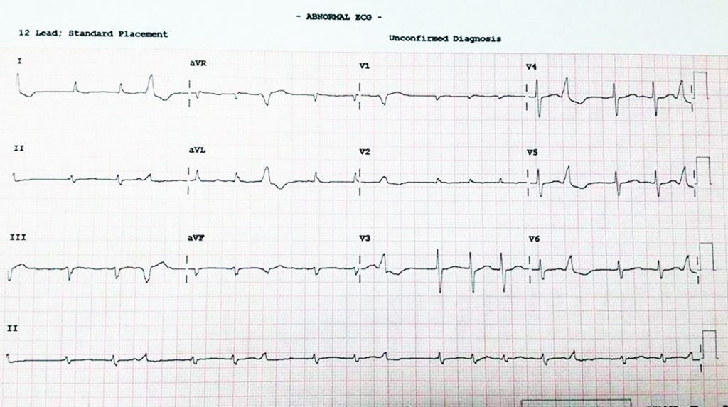 心室性期外収縮 | ECG-Cafe