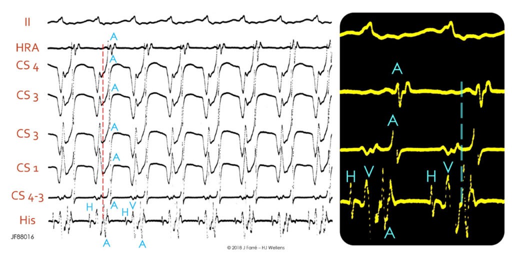 AVNRTの特徴的変化 | ECG-Cafe