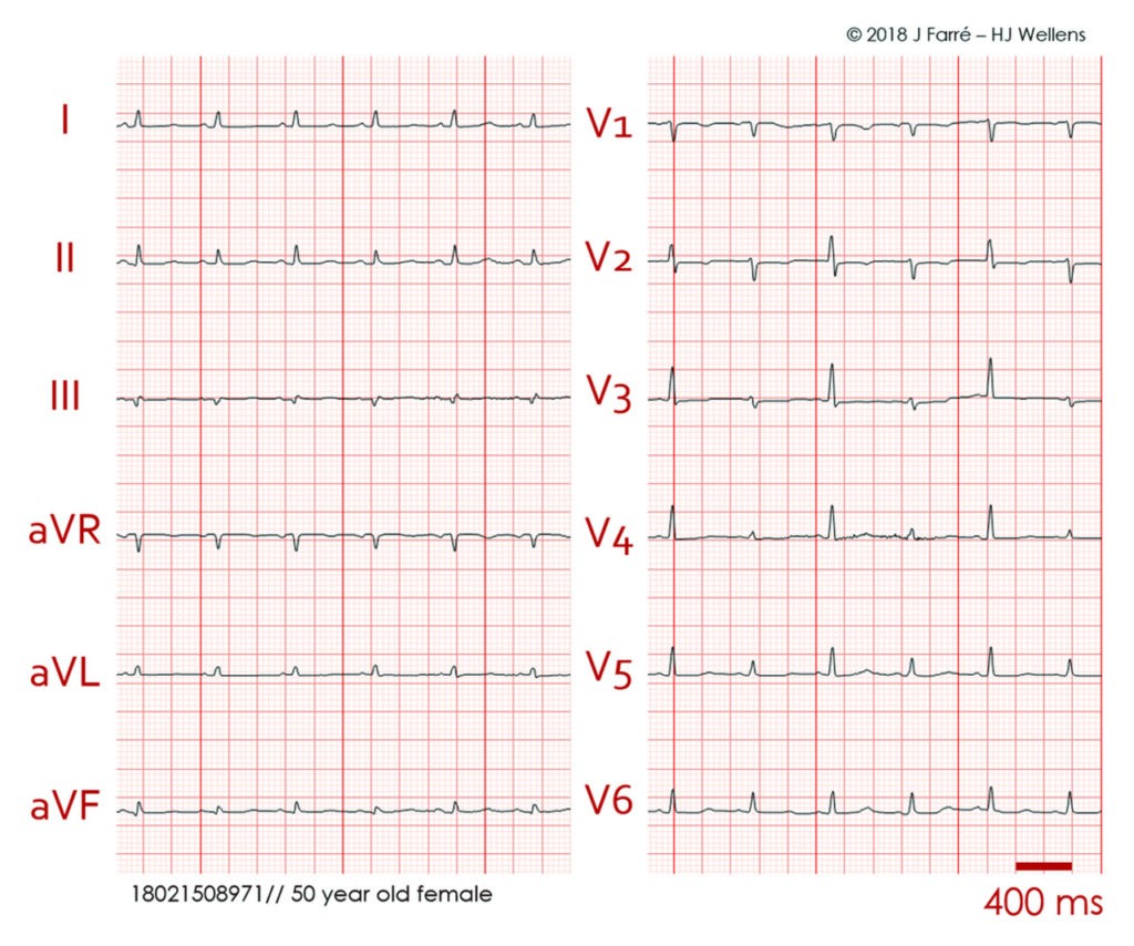 低電位 | ECG-Cafe