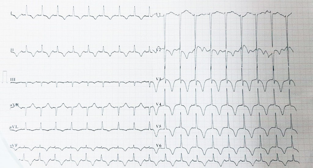 たこつぼ型心筋症 | ECG-Cafe