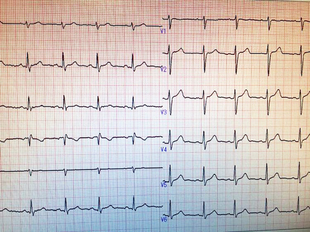 モニター心電図（正常洞調律） | ECG-Cafe