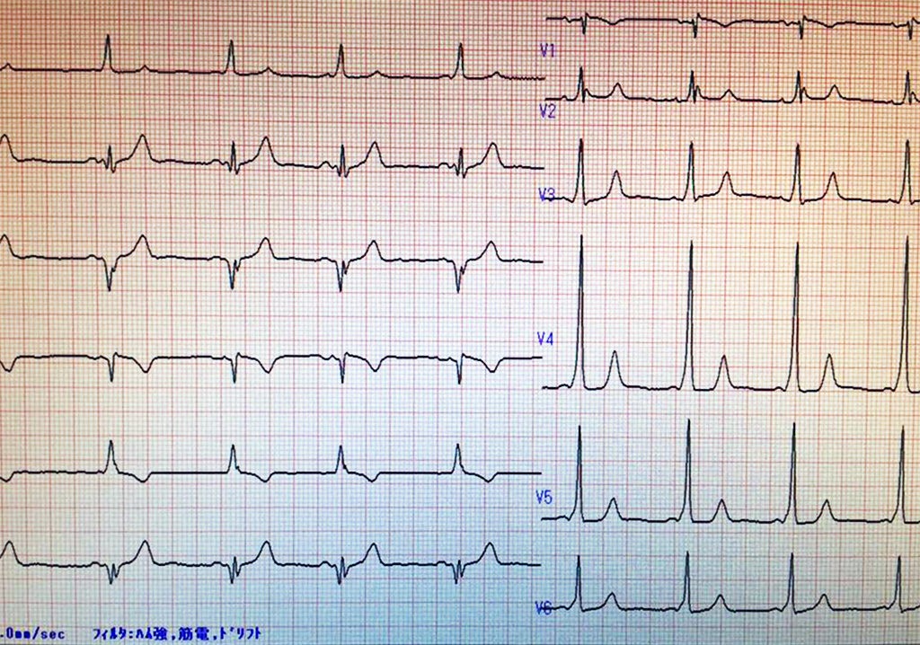 間欠性WPW症候群 | ECG-Cafe