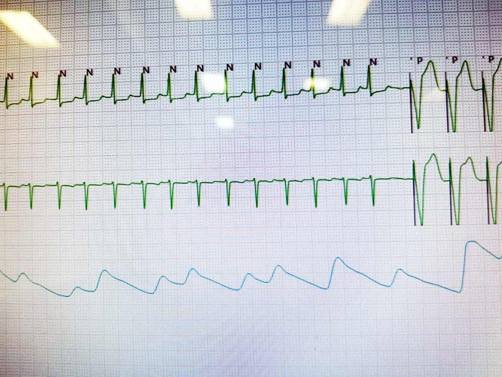 心房粗動のページを公開しました | ECG-Cafe
