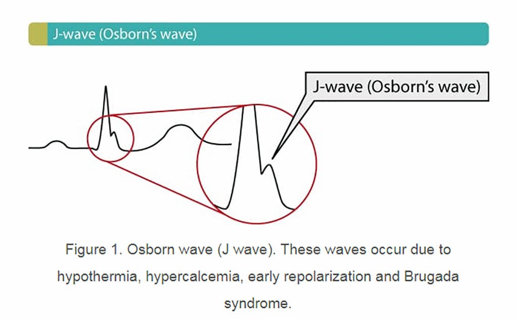 J波 (オズボーン波) | ECG-Cafe