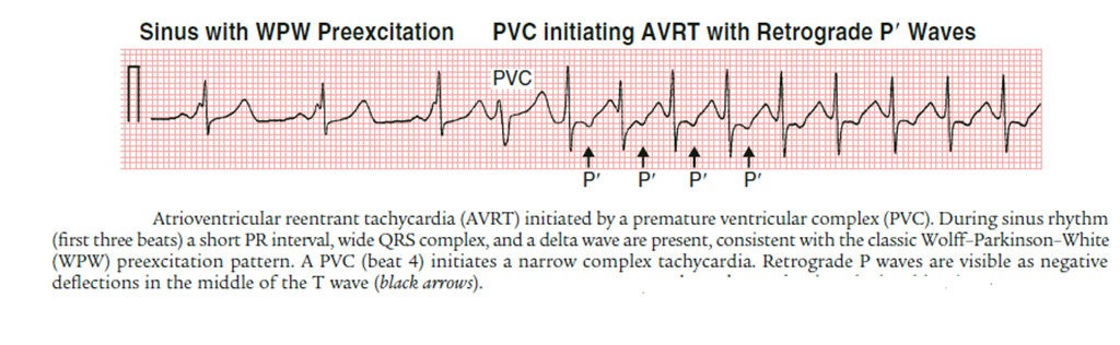 3つの特徴的な波形 | ECG-Cafe