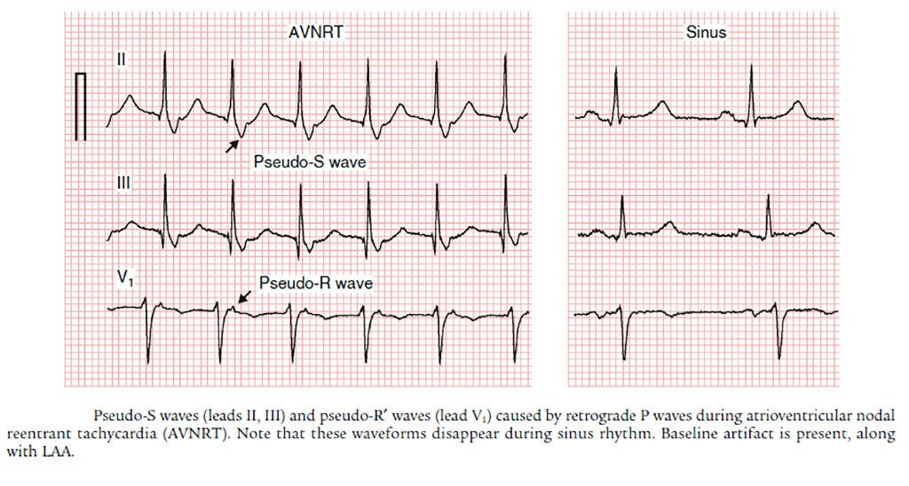 発作性上室性頻拍 | ECG-Cafe