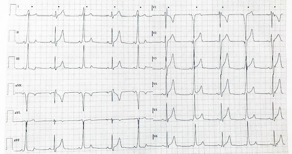 間欠性WPW症候群 | ECG-Cafe