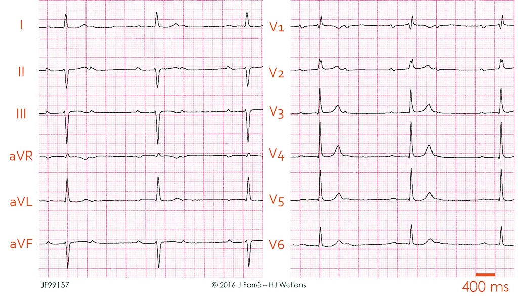 PQ間隔の延長なしにQRS波形が脱落 | ECG-Cafe
