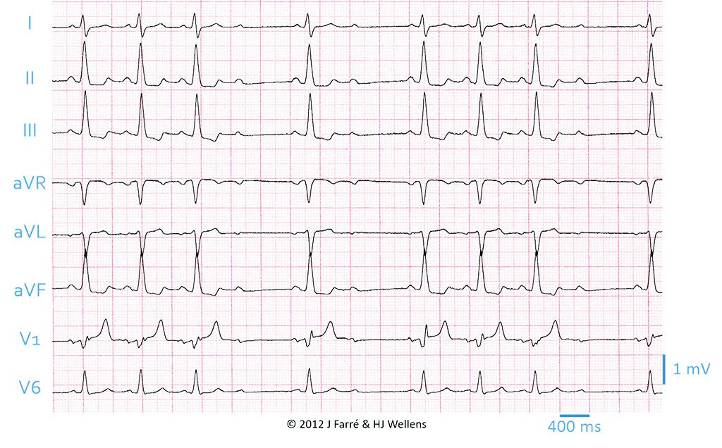 2：1伝導の高度房室ブロック | ECG-Cafe