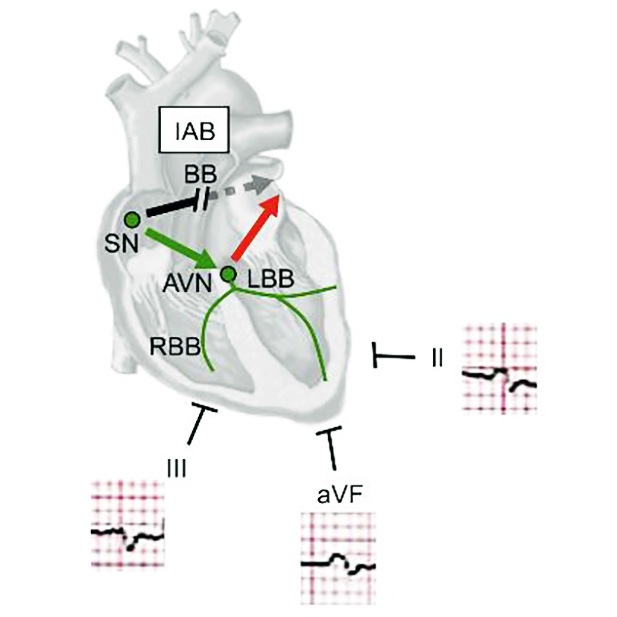 Bayés’ Syndrome | ECG-Cafe