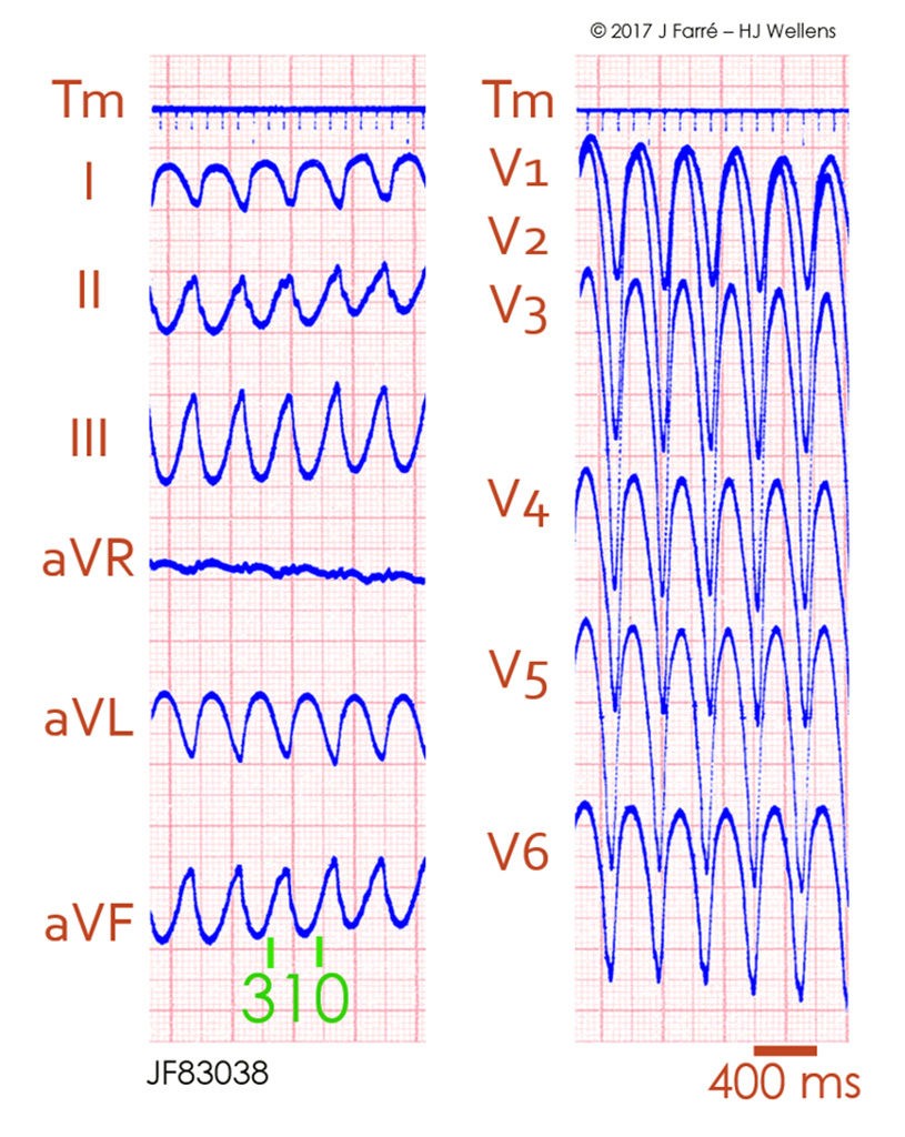 wide QRS tachycardiaの鑑別 | ECG-Cafe
