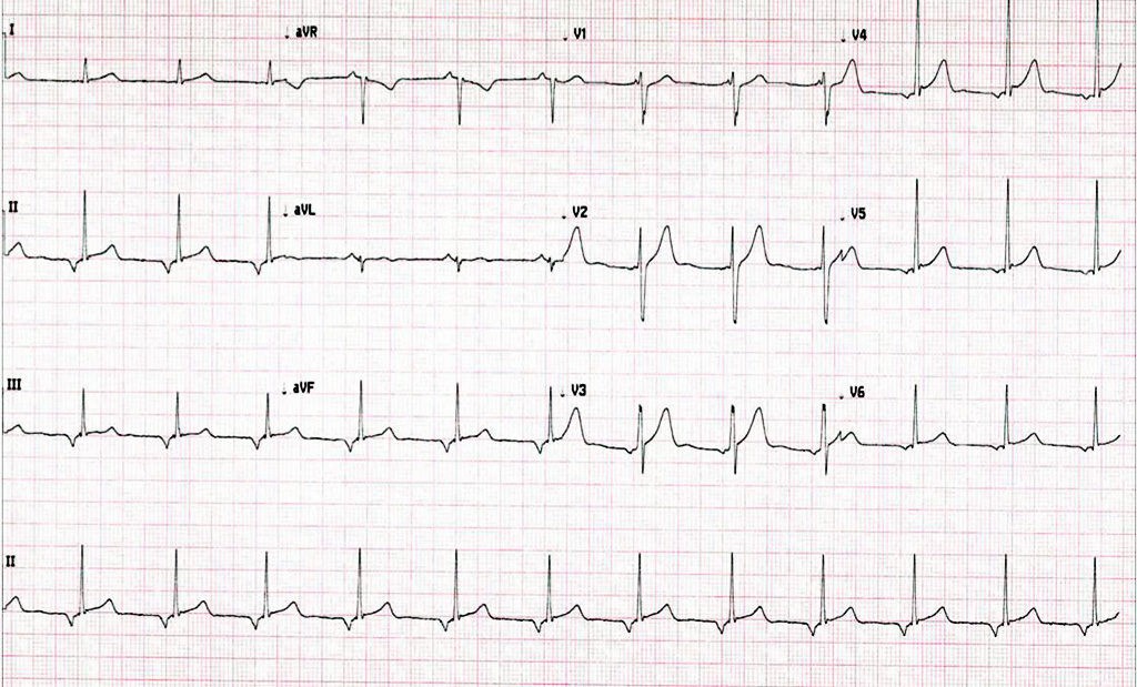 (刺激)伝導系 | ECG-Cafe