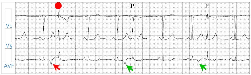 房室ブロックを伴う上室性期外収縮 | ECG-Cafe