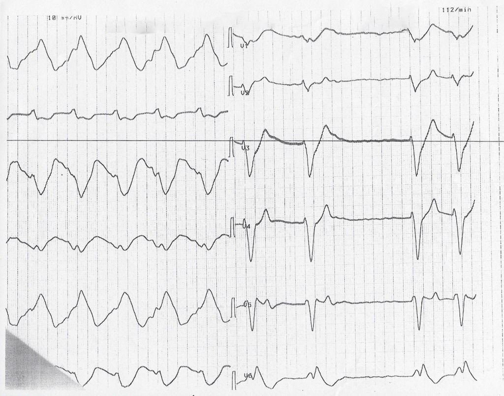 カリウムの値による心電図変化 | ECG-Cafe