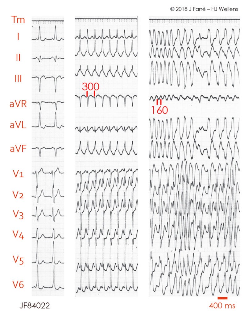 発作性上室性頻拍 | ECG-Cafe