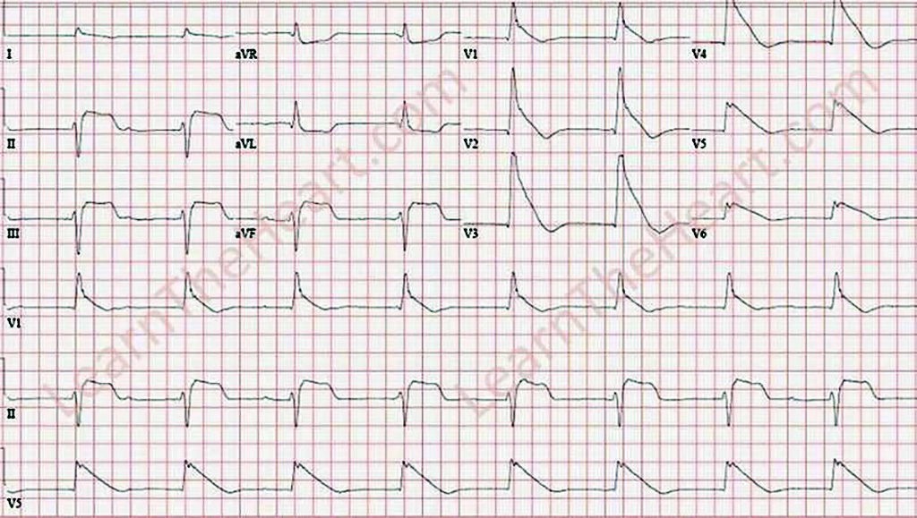 完全房室ブロック Part.2 | ECG-Cafe