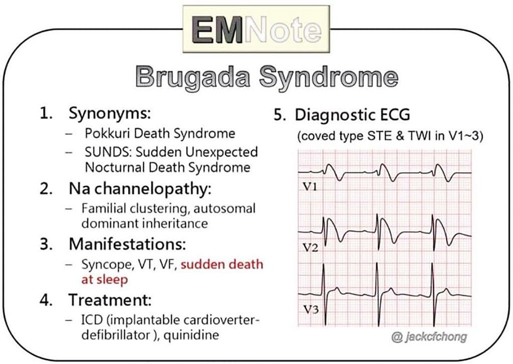 coved型のST上昇 | ECG-Cafe