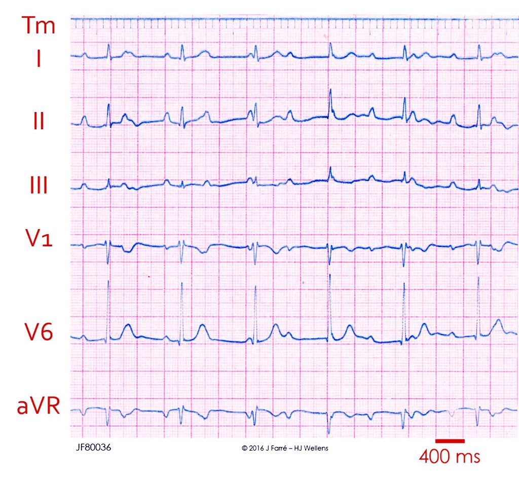 完全房室ブロック Part.1 | ECG-Cafe