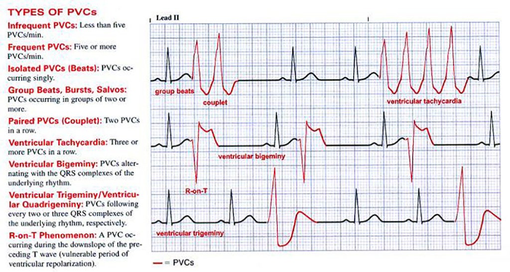 三段脈 | ECG-Cafe