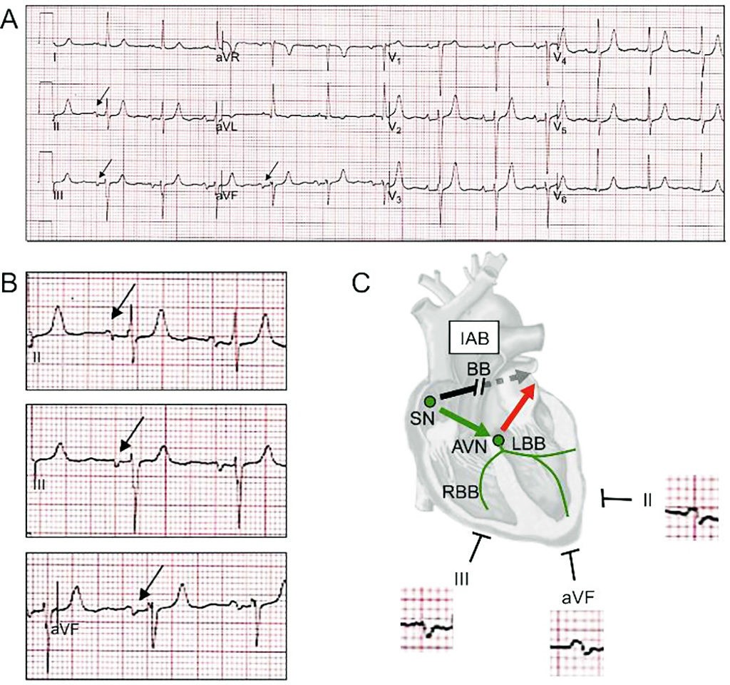 Bayés’ Syndrome | ECG-Cafe