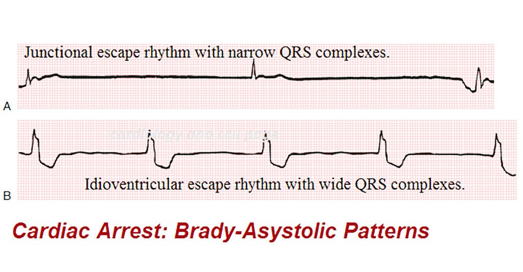 完全房室ブロック Part.1 | ECG-Cafe
