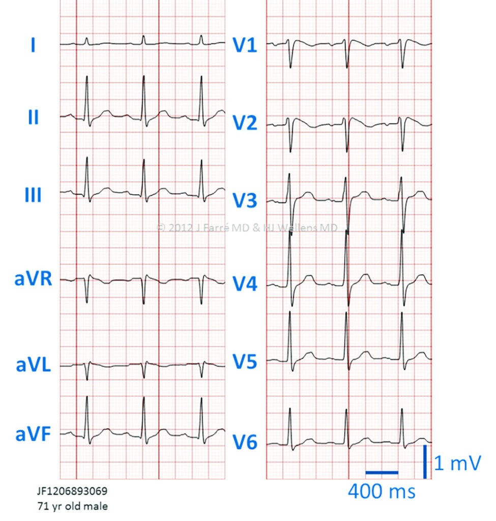 ブルガダ心電図 | ECG-Cafe